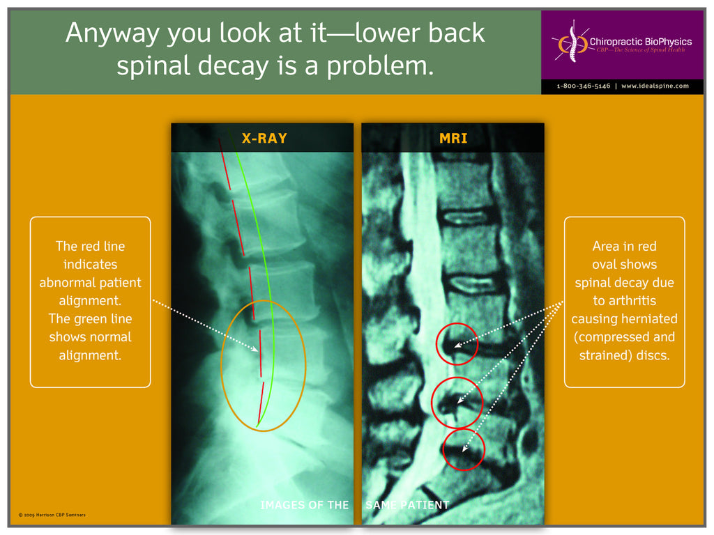 disc herniation x ray