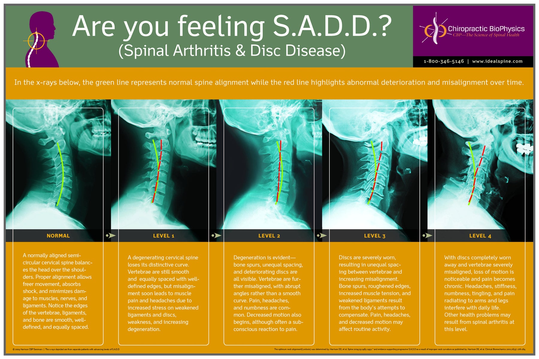 Spinal Arthritis & Disc Disease S.A.D.D. – Chiropractic BioPhysics